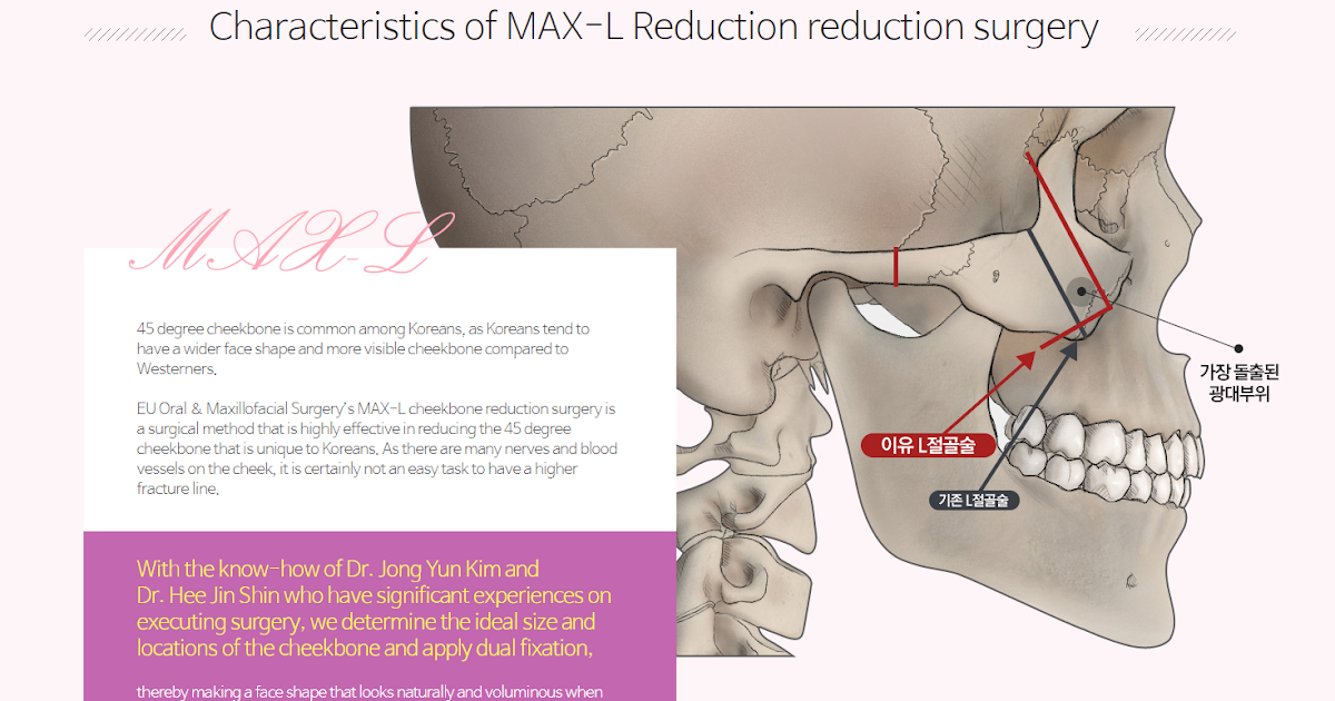 Zygoma reduction (cheekbone surgery) at EU