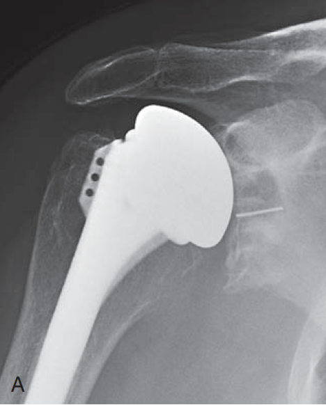 UW Shoulder and Elbow Academy: The importance of the humeral osteotomy ...