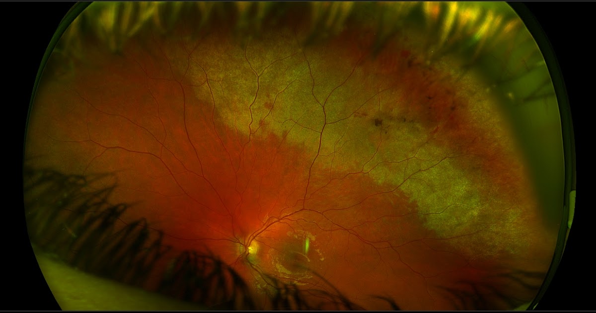Sonoran Desert Eye Center: COMMOTIO RETINAE WITH VITREOUS HEMORRHAGE