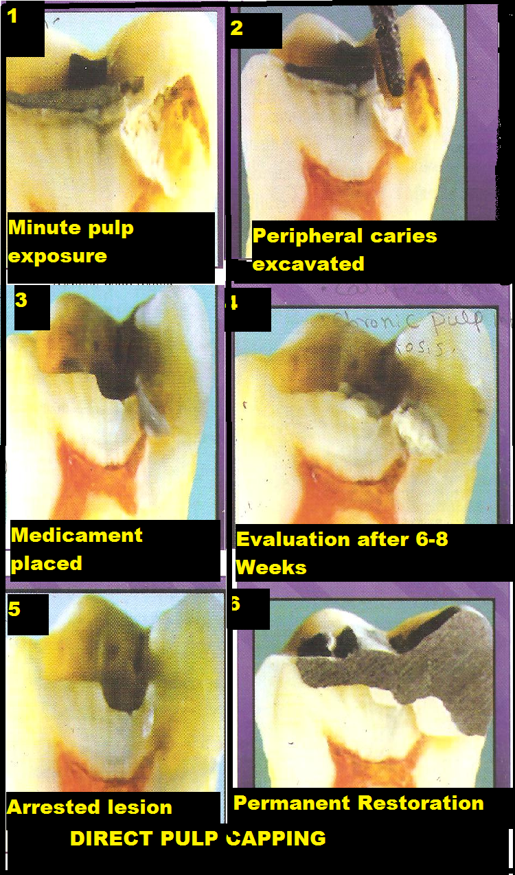 Common Dental Problem And Solution: Endodontic treatment in children ...