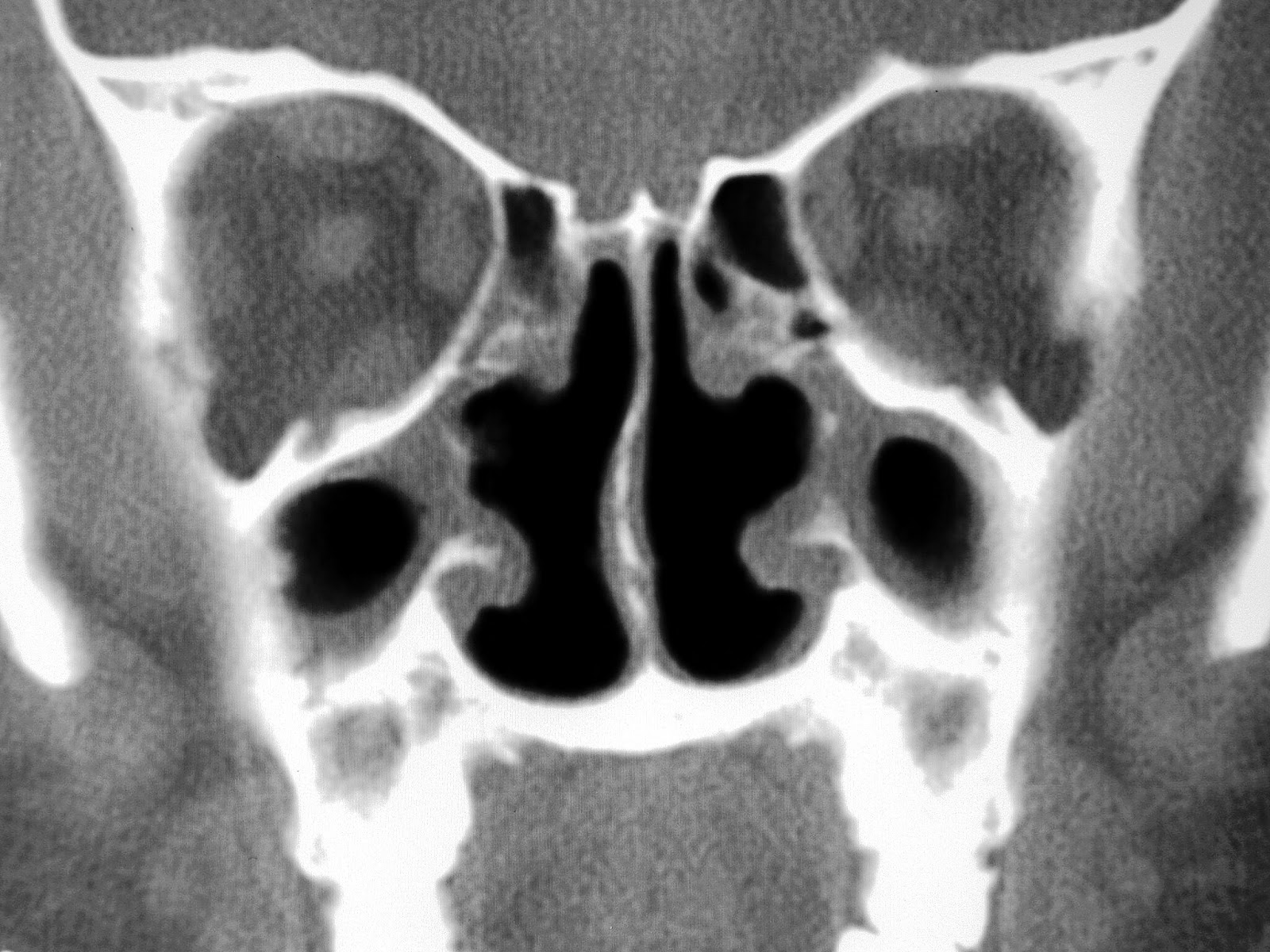 ENT Blogs: ATROPHIC RHINITIS