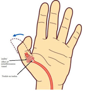 Look What You Are Suffering From...: TRIGGER THUMB