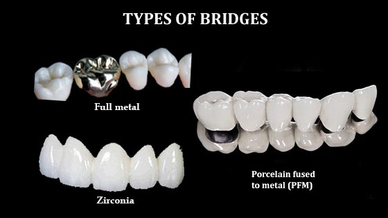 Porcelain Fused To Metal Bridge