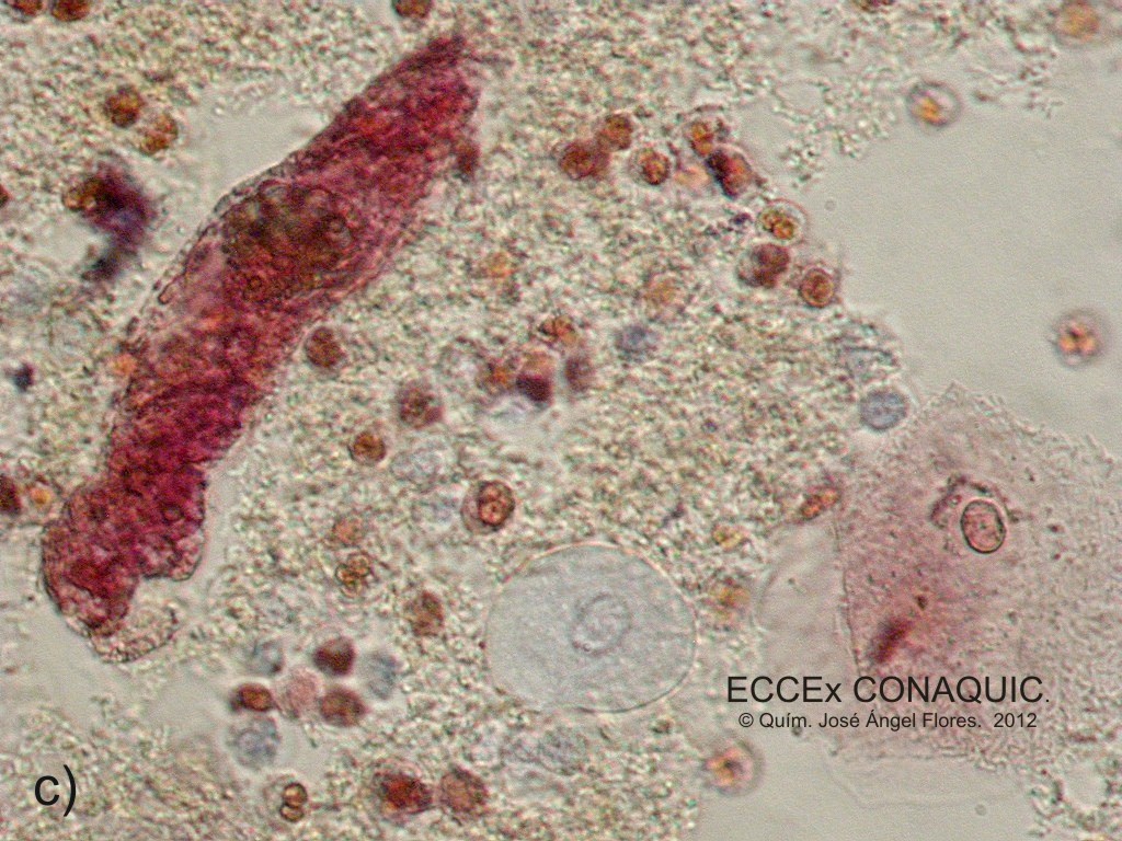 Examen General de Orina: Caso UR- abril -12. (Enfoque: Daño renal)