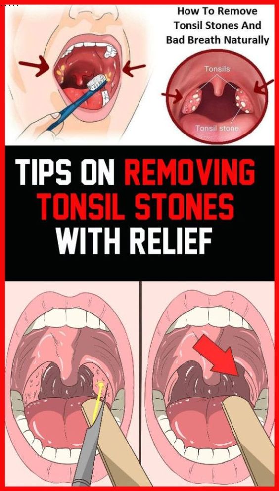 Tips On Removing Tonsil Stones With Relief ! - wellness magazine