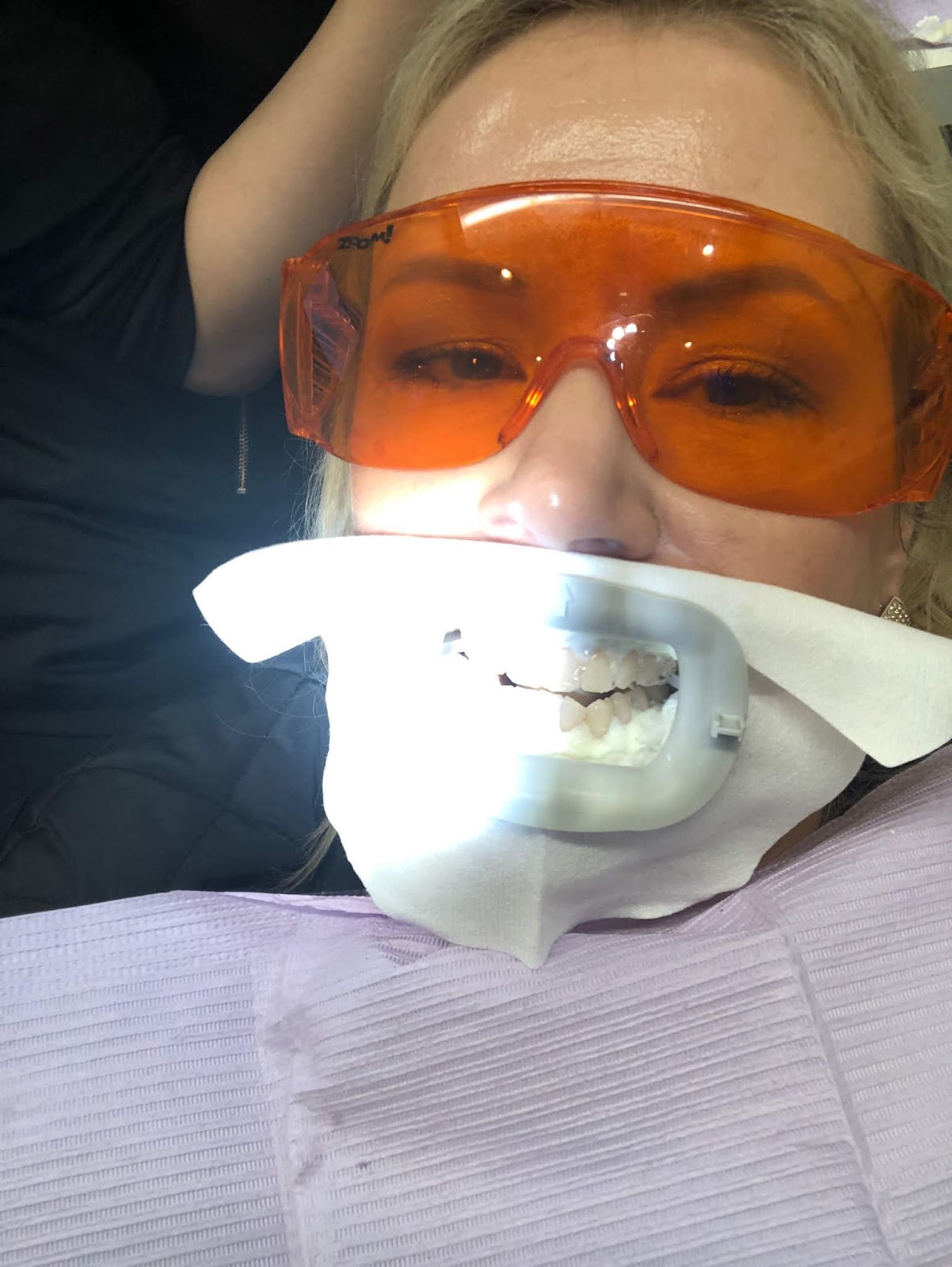 My Philips ZOOM! Teeth Whitening experience with before and after!