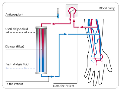 Dialyser Machine an artificial kidney