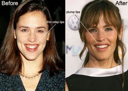 Jennifer Garner Lip Injections