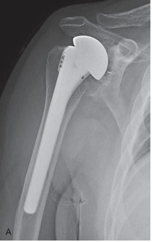 UW Shoulder and Elbow Academy: The importance of the humeral osteotomy ...