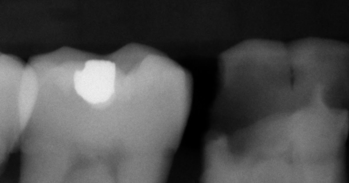 Getting a good contact with large GICs