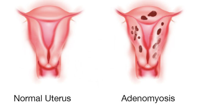 Adenomyosis Symptoms Causes And Treatments Dr Rama Sofat Hospital