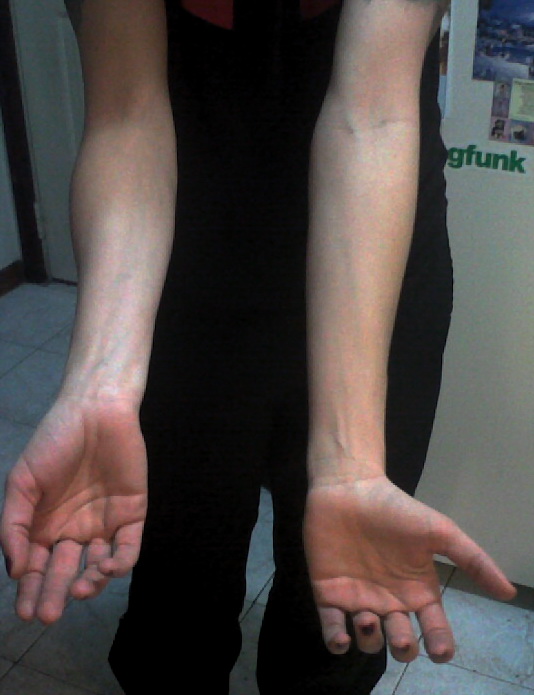 Zsani Fights Breast Cancer: AXILLARY WEB SYNDROME