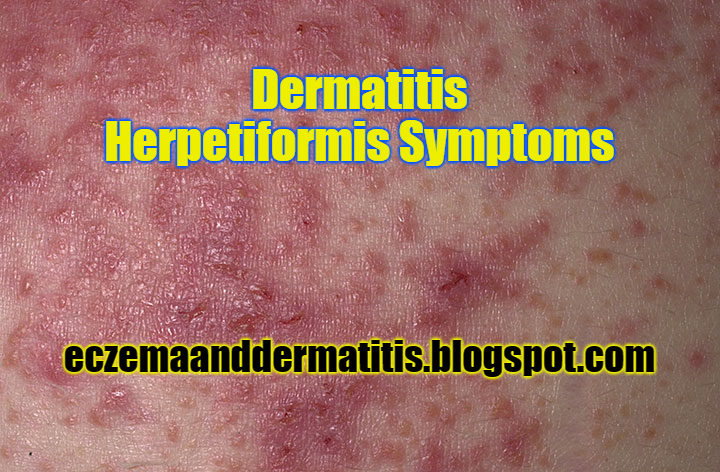 Dermatitis Herpetiformis Symptoms - Eczema and Dermatitis