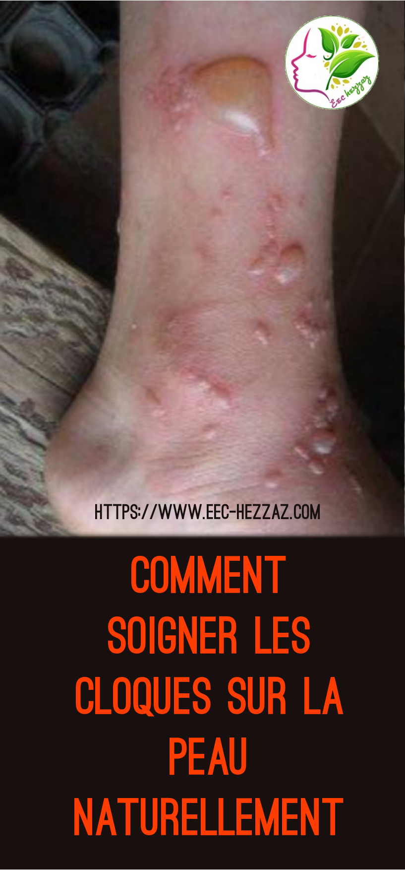 Les cloques sur la peau : comment les soigner naturellement