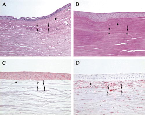 neuropathology blog: Salzmann nodular degeneration of the cornea