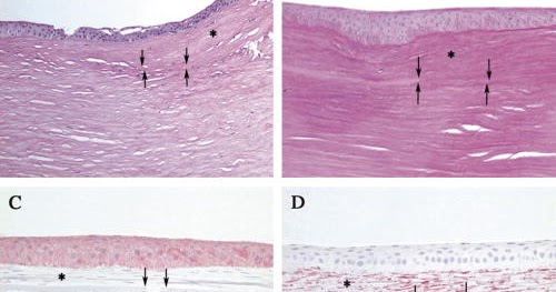 neuropathology blog: Salzmann nodular degeneration of the cornea