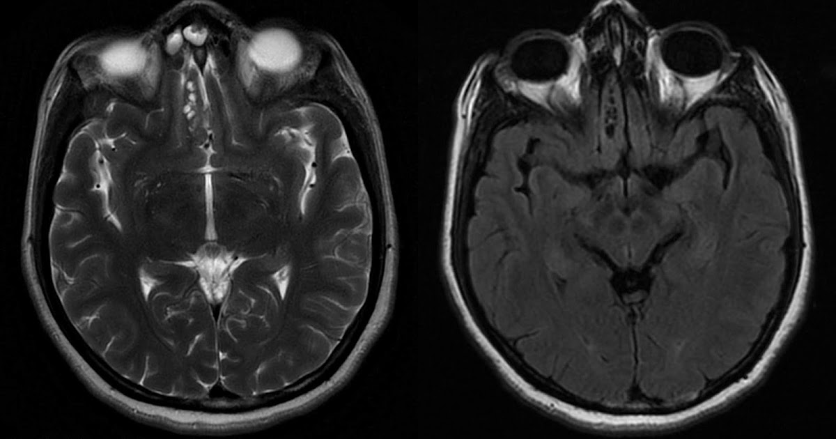 Dr Balaji Anvekar FRCR: Cysts in gyrus rectus of frontal lobe