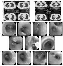 Medical Treatment Pictures-for Better Understanding: Bronchoscopy ...