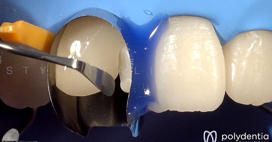 OPERATIVE DENTISTRY: Class III anterior direct composite restoration ...