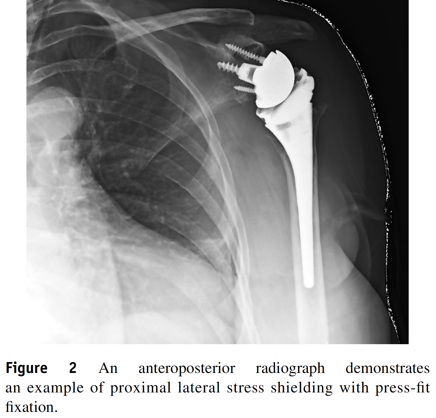 UW Shoulder and Elbow Academy: Reverse total shoulder - humeral stress ...