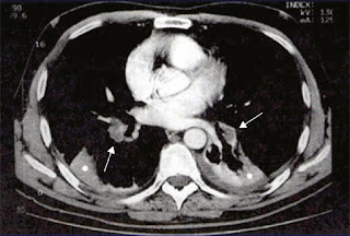 MUNDO ENFERMEDADES: DIAGNÓSTICO EMBOLIA PULMONAR