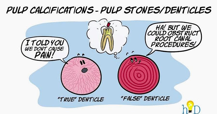 PULP CALCIFICATIONS: Pulp stones (Denticles) and Diffuse linear ...