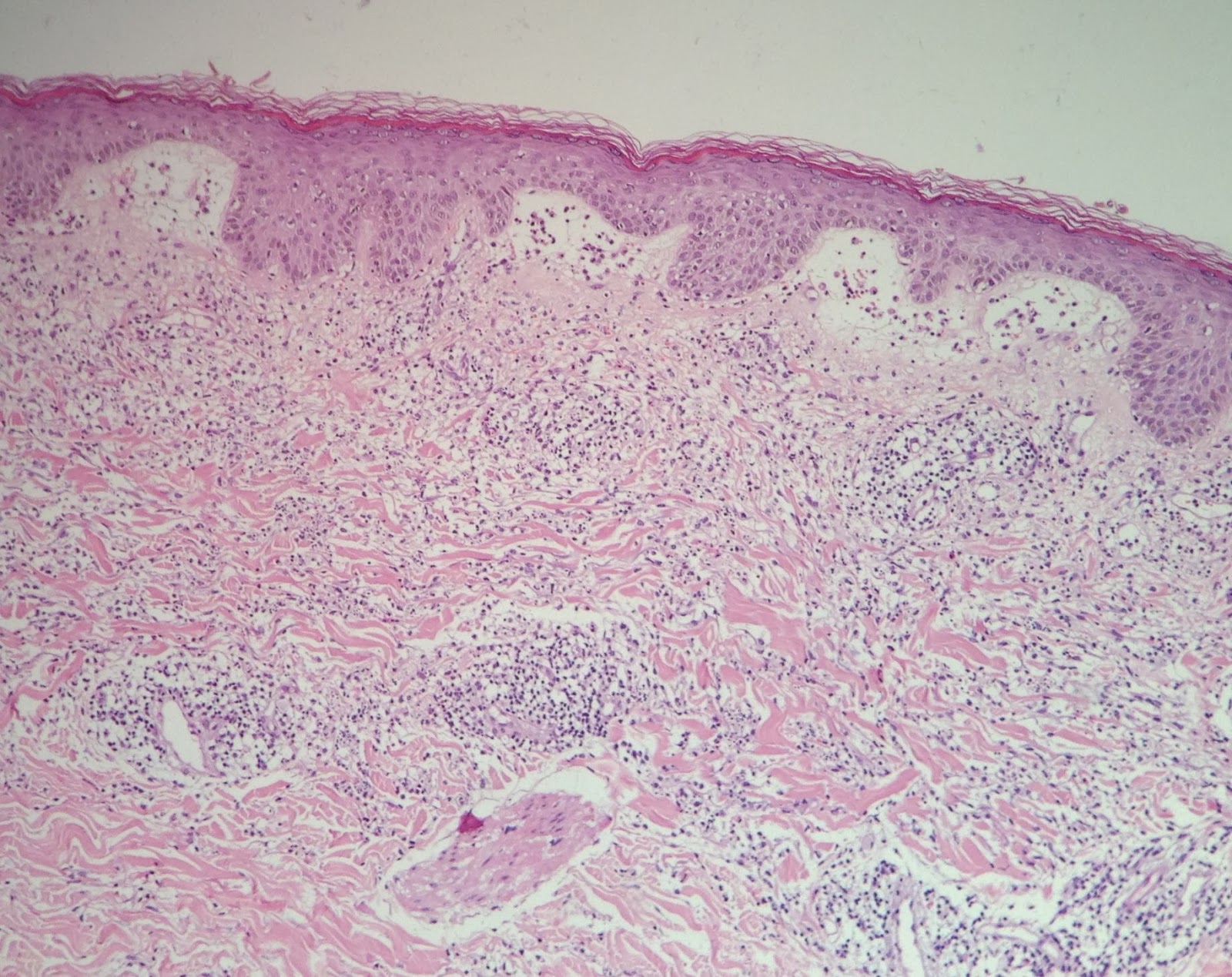 dermatopatologia para iniciantes: DERMATOSE NEUTROFÍLICA