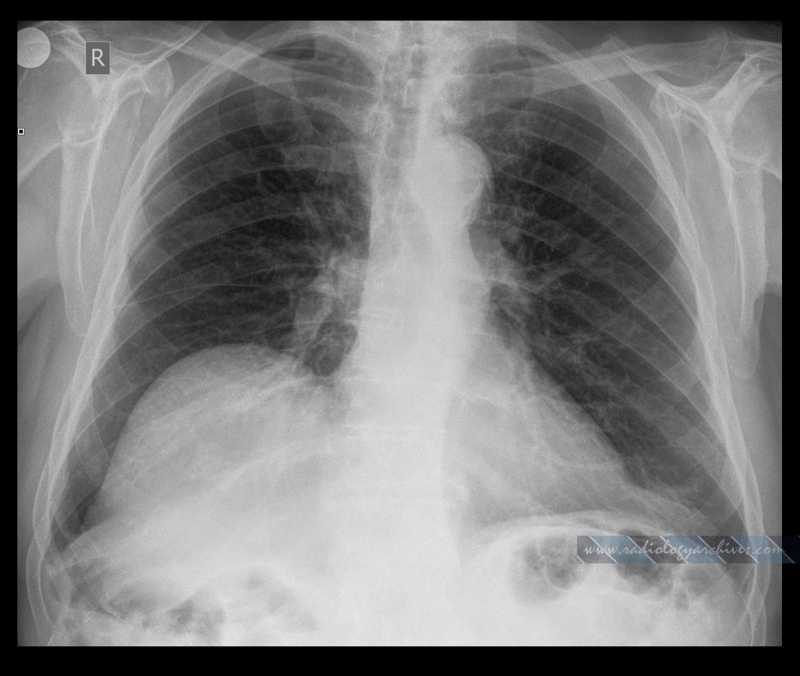 Radiology Archives: Ύβωση Ημιδιαφράγματος (Eventration of Diaphragm)
