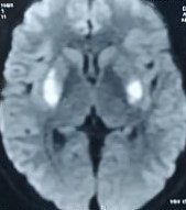 Methanol Poisoning : MRI - Sumer's Radiology Blog