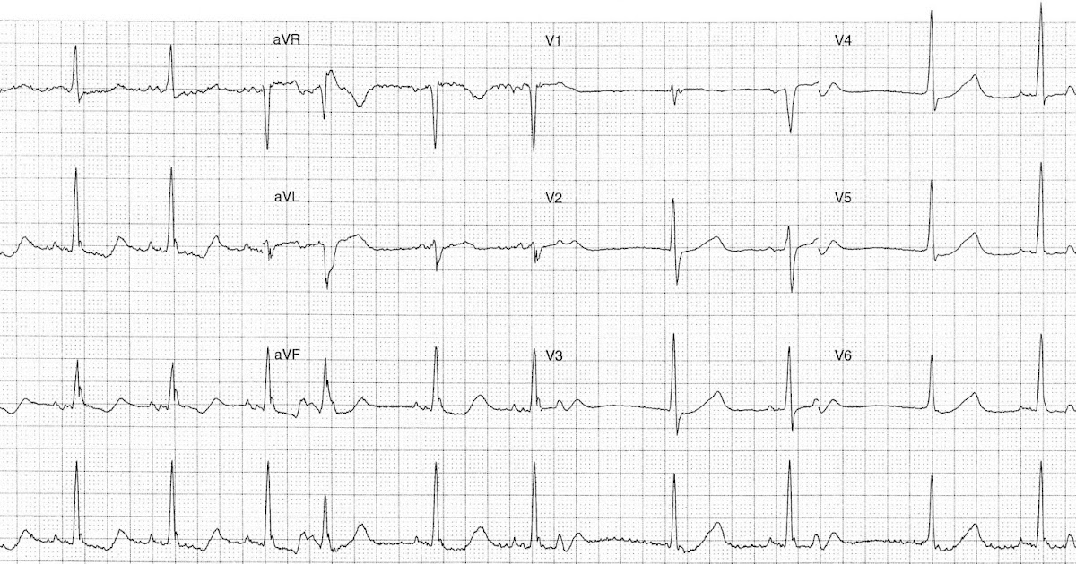 ECG of the Week: ECG of the Week - 24th July 2017 - Interpretation