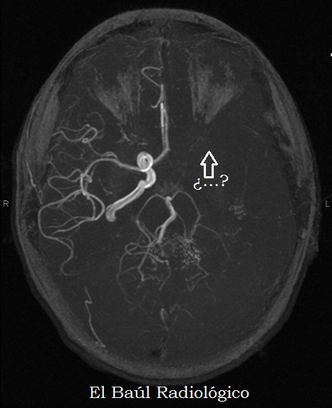 El Baúl Radiológico: ARTEFACTOS EN LAS IMÁGENES DE IRM, PRODUCIDOS POR ...