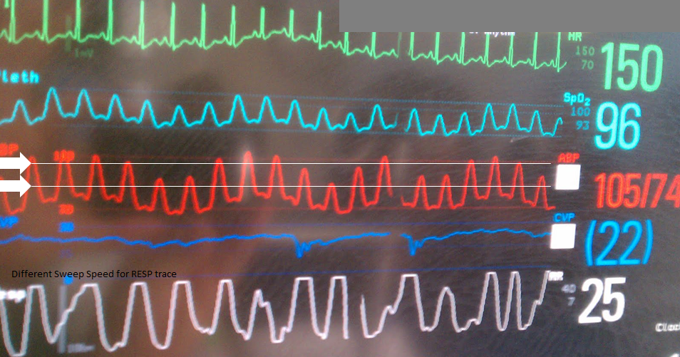 Pedi cardiology: Pulsus Paradoxus