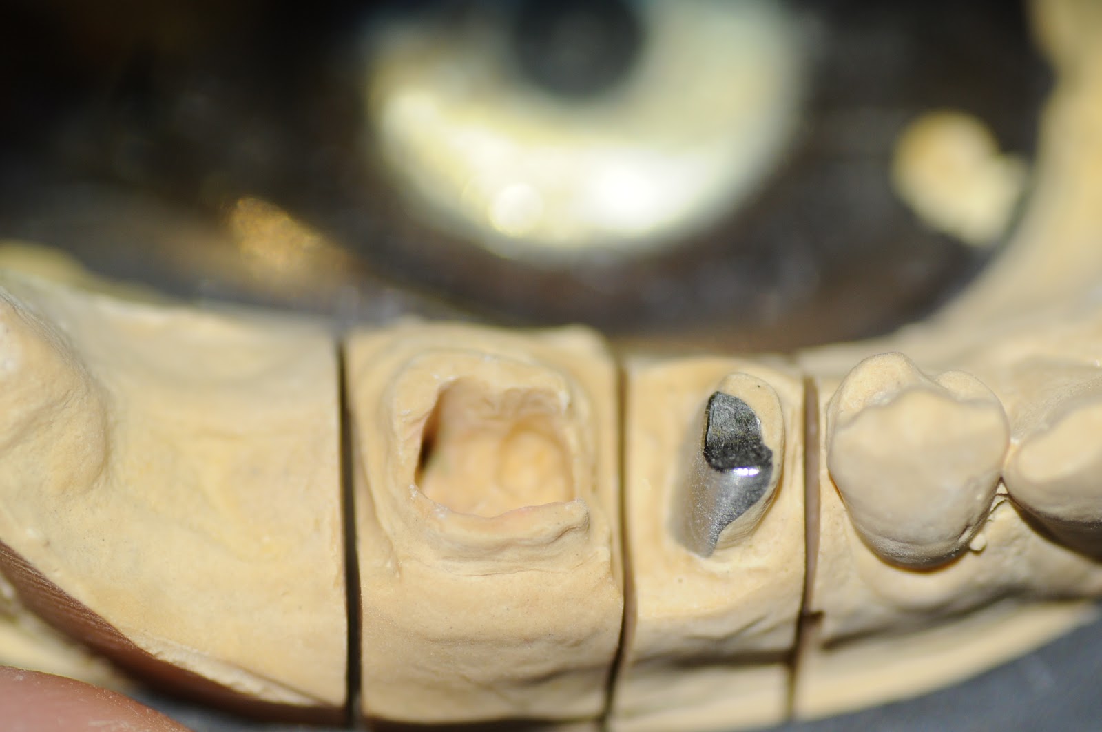 Empreintes TFM: Tenon faux moignon IC: Inlay core ACR: Ancrage corono ...