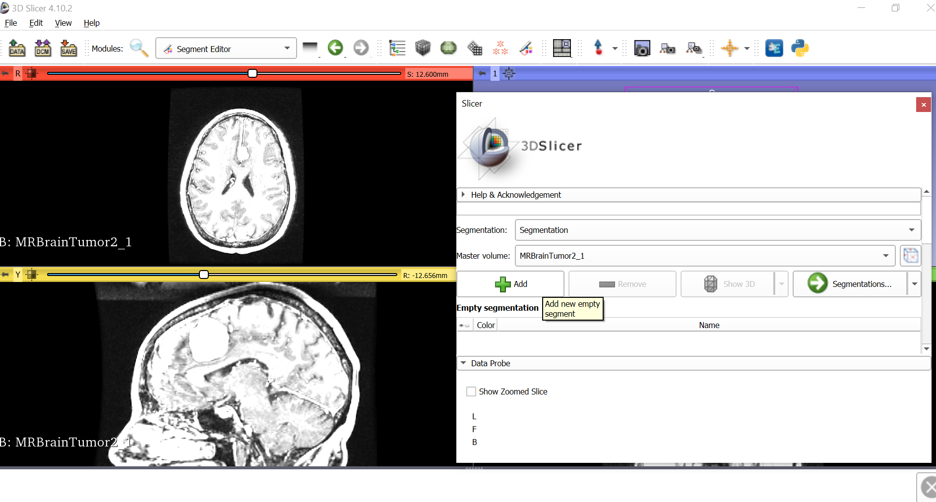 Everything Modelling and Simulation: Medical Image Segmentation with 3D ...