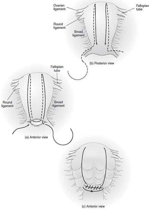 Surgical Management of Postpartum Hemorrhage Case File