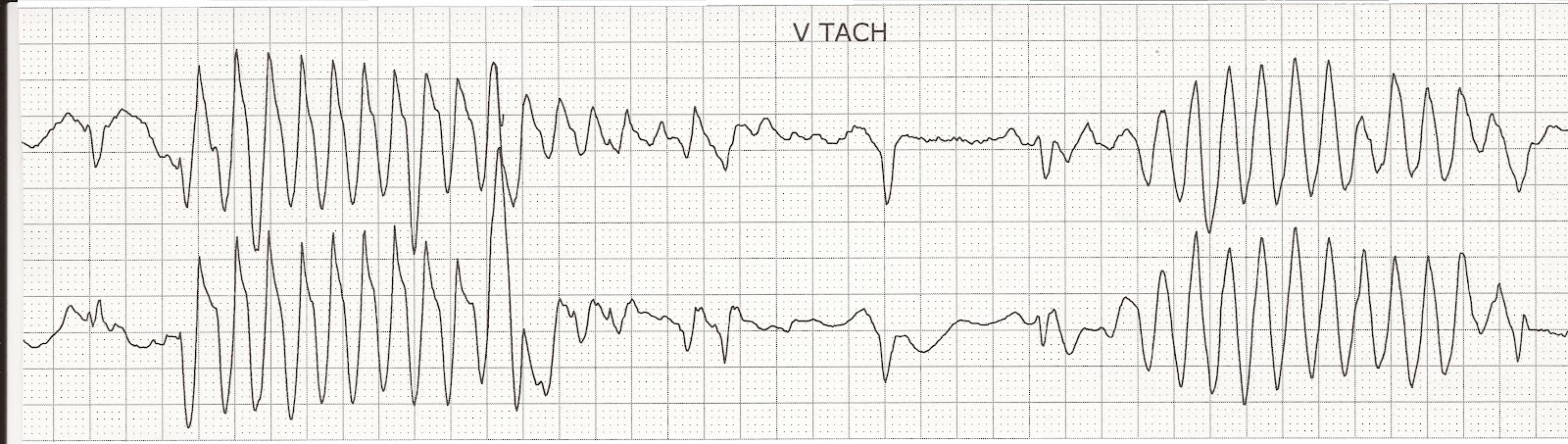 Float Nurse: Identify the appropriate electrical intervention for the ...