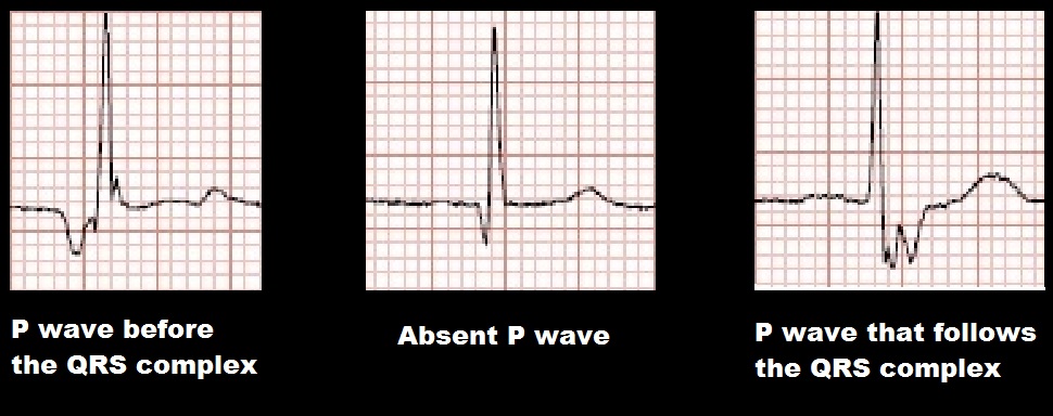 Characteristics of Junctional Rhythms