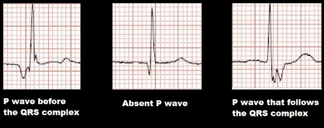 Characteristics of Junctional Rhythms