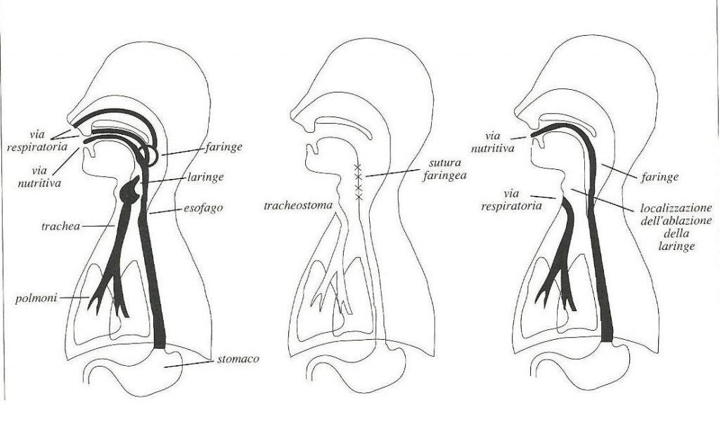 Laringe artificiale - Искусственная гортань - Artificial larynx