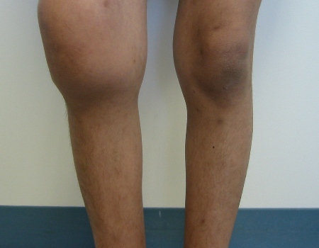 Study Medical Photos: A Brief Discussion On Clotting Disorders