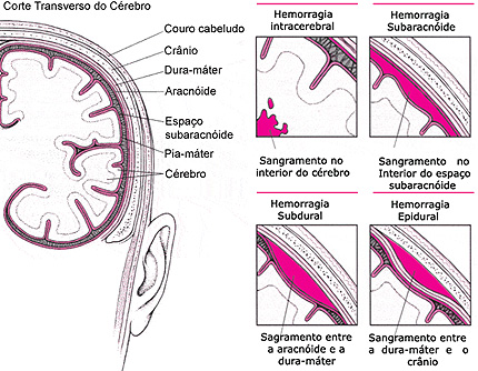 X-RAYview: Hemorragia SUBARACNOIDEA