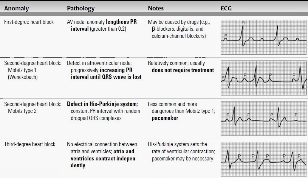 Types Of Heart Blocks