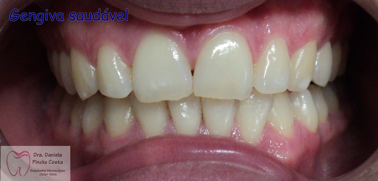 Dra. Daniela Pincke Costa: Gengiva Saudável X Gengivite