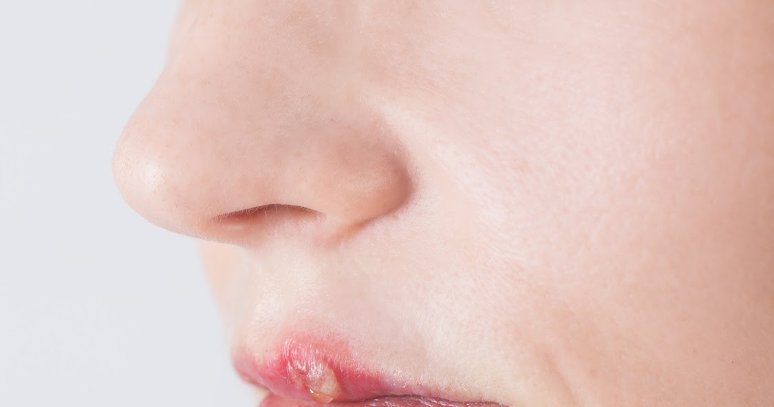 Des solutions naturelles et remèdes pour traiter l'herpès labial