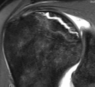 UW Shoulder and Elbow Academy: Avascular necrosis of the humeral head ...