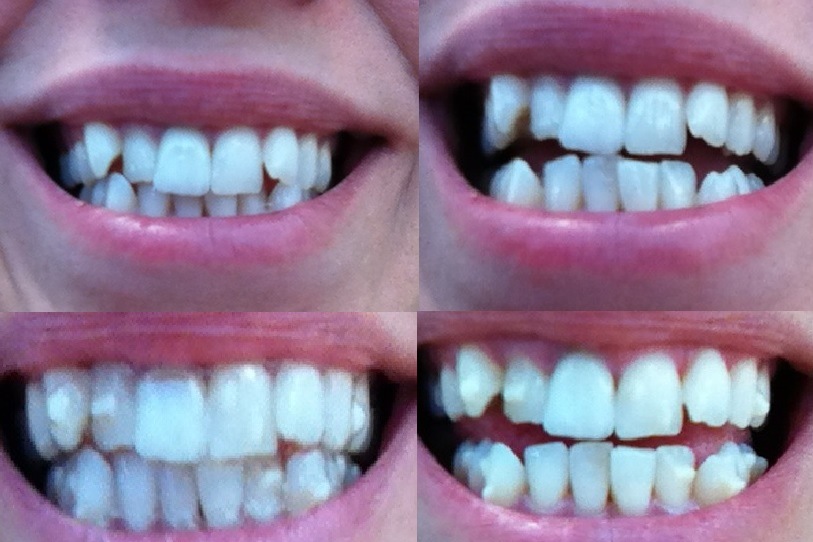 Michelle's Invisalign Journey: Tray 7