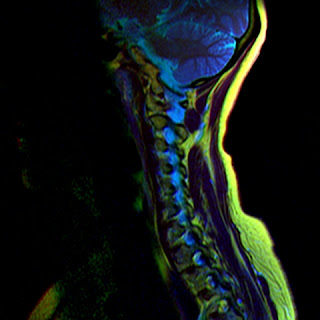 Nevit's blog: Cervical spine Color MRI