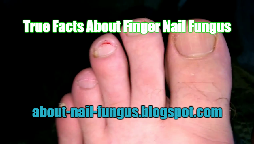 True Facts About Finger Nail Fungus - About Nail Fungus