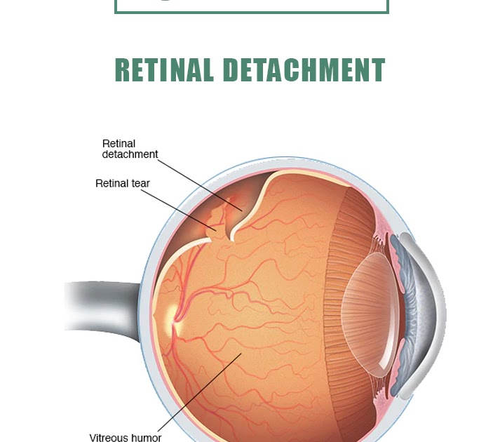 What is Retinal Detachment and Various Types of Surgeries?