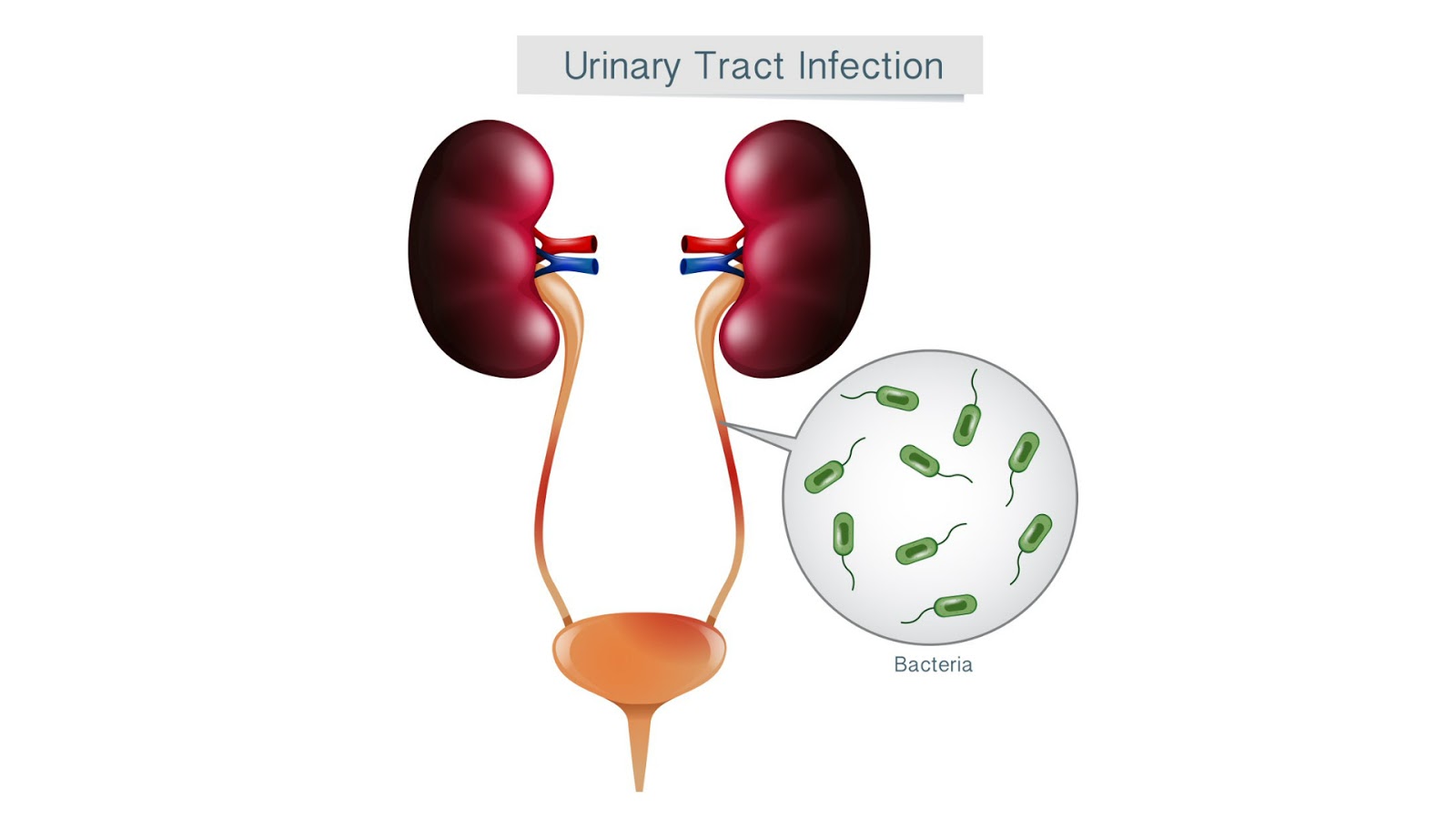 Men’s Health - Urinary Tract Infection (UTI)